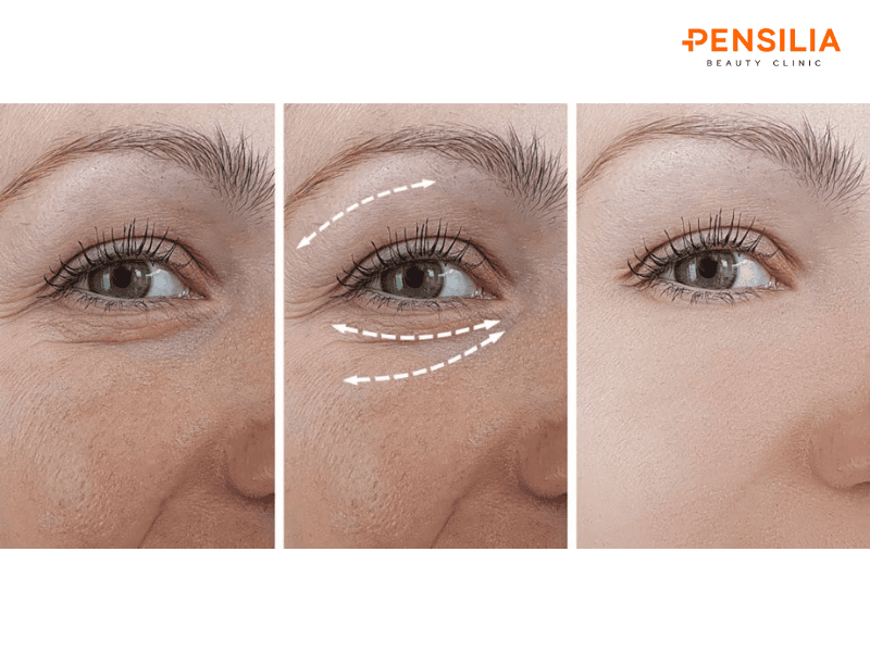 Căng chỉ vùng đuôi mắt sắc sảo, xoá nhăn hiệu quả - Pensilia